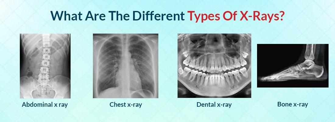 What Are Digital X-Rays? Know Their Uses, Types And Risks